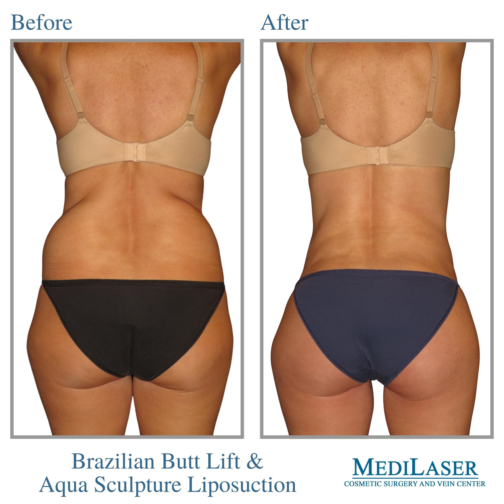 BBL Before & After | Medilaser | Frisco, TX