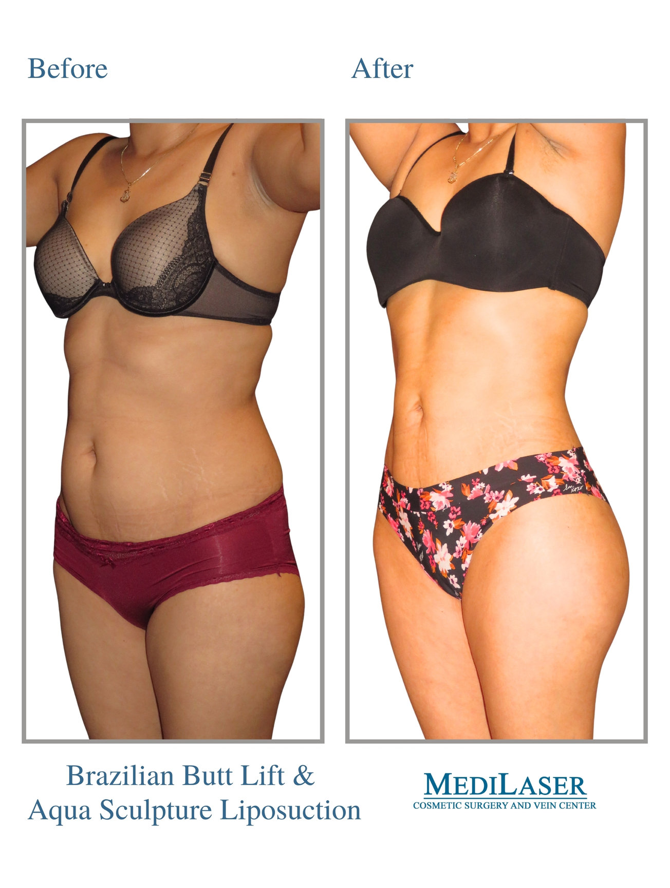 BBL Before & After | Medilaser | Frisco, TX